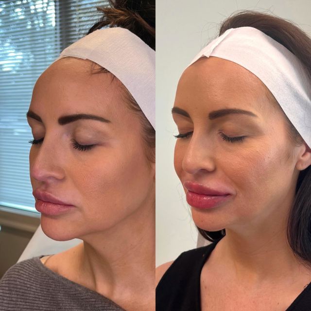 Ecobel Med Spa | Leading PDO Thread Experts in Atlanta